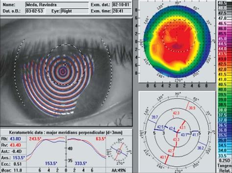 Corneal Topography Final Pptx