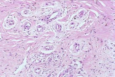 Pseudo Kaposi Sarcoma Acroangiodermatitis Practice Essentials
