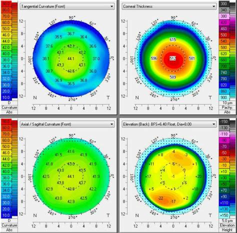 Four Map Composite Pentacam Image Of The Left Cornea Of A 22 Year Old