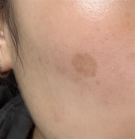 부산 피부과 흑자제거 내돈내산 후기리팟레이저 아님 네이버 블로그