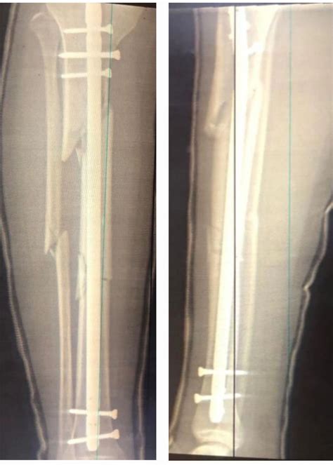 Segmental Tibial Fracture Orif Fracture Revision Tibia Mohamed Esawy