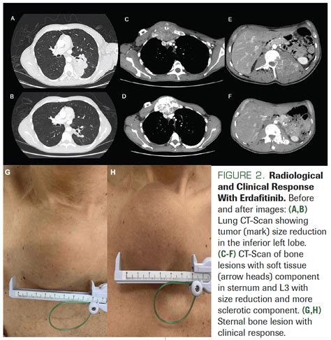 Erdafitinib In The Treatment Of Metastatic Urothelial Carcinoma