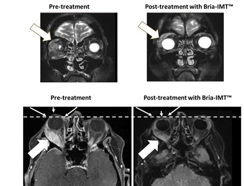 Briacell Images Confirm Robust Anti Tumor Activity In