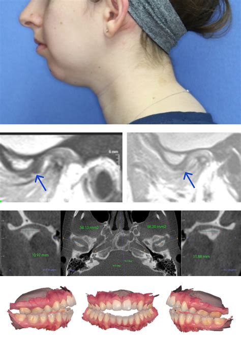 Idiopathic Condylar Resorption Reality Or Myth Spear Education