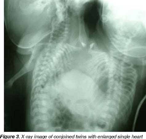 Conjoined Twins Abby And Brittany X Ray Pdf Conjoined Twins Report