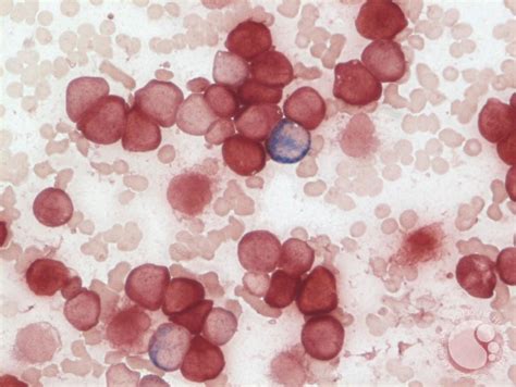 Aml Monocytic Esterase Stain