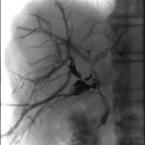 Percutaneous Transhepatic Biliary Drainage Cholangiogram Revealed Download Scientific Diagram