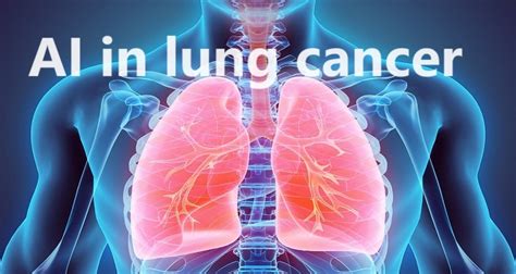 Revolutionizing Lung Cancer Care How Ai Is Transforming Detection