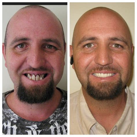 Dentures At 40 Holt Dentures