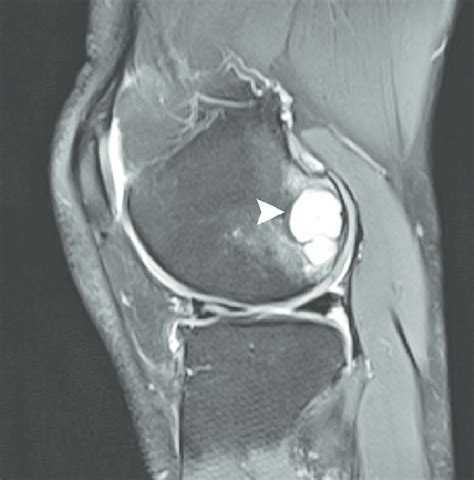 Intraosseous Ganglion Cyst Sagittal Fs T2 Wi Showing A Well Delineated