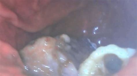 Long Vore Exploration With Pillcam In Vr With Pillcam For Compatible