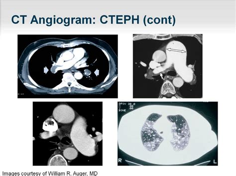 Ppt A Framework For Diagnosing And Treating Cteph Powerpoint Presentation Id 6859948