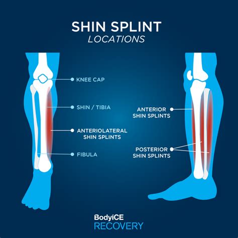 Shin Splint Recovery Symptoms Prevention And Recovery Time Guide