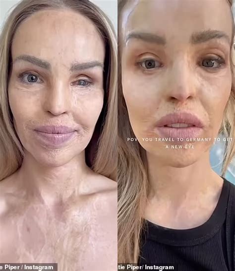 Celeb Katie Piper Shows Off Her New Glass Eye In Remarkable Before