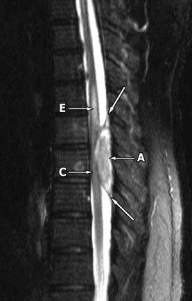 Epidural Abscess Radiology Key