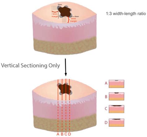 Understanding Melanoma In Situ Lentigo Maligna Surgical Treatment