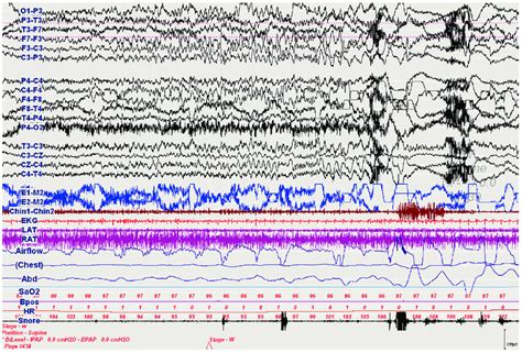 Temporal And Spatial Propagation Of The Sharp Wave Activity That