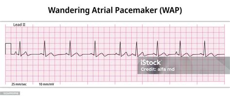 Ecg Wandering Atrial Pacemaker 8 Second Ecg Paper Stock Illustration
