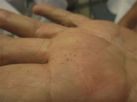 Spiny Keratoderma Exposes Underlying Renal Cell Carcinoma Jaad Case Reports