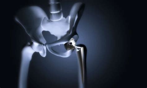 Anterior Vs Posterior Hip Replacement Surgery Pros And Cons