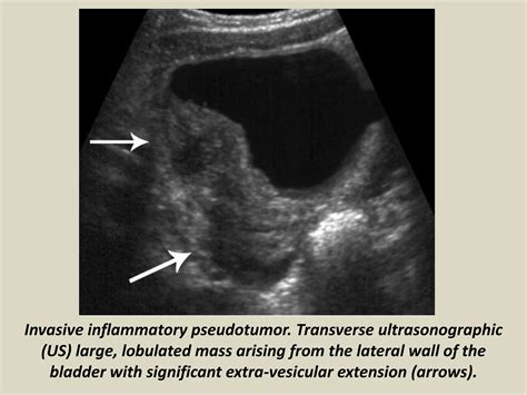 Presentation1pptx Ultrasound Examination Of The Urinary Bladder And