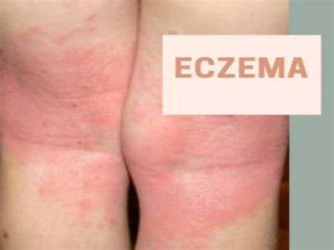 Best Dermatologists For Eczema Treatment In Singapore By Health Springs Group On Dribbble