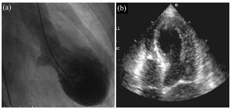 A Left Ventriculogram Right Anterior Oblique Projection In