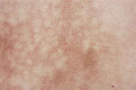 Erythema Ab Igne Fade Erythema Ab Igne Usual Site Unusual Cause Ozix