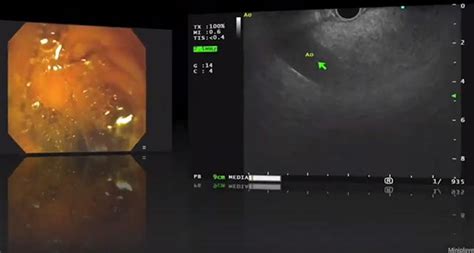 Tokyo Classification Cholangitis Guidelines Endoscopy Campus