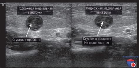 Тромбоз вен верхних конечностей кратко с точки зрения терапии