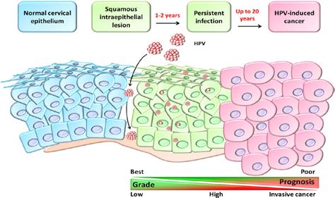 Cervical Cancer Cartoon Showing A Schematic Hpv Infection Leading To