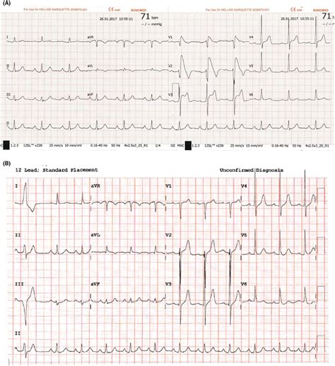 A St Segment Elevation At Precordial Leads Consistent With A