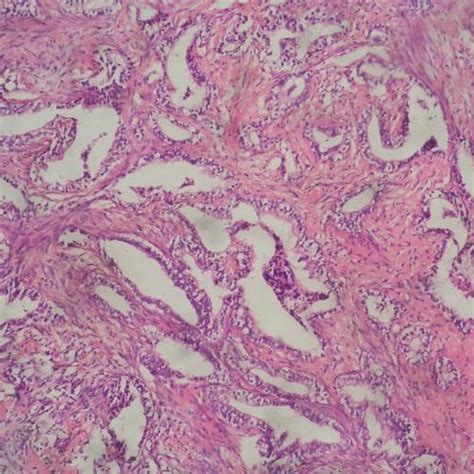 Diffuse Swelling And Thickening Of Vulva With Multiple Vesicles Over