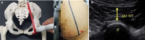 Figure 1 From Reliability Of Rehabilitative Ultrasound Imaging For