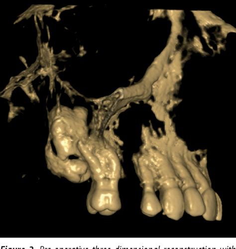 Figure 2 From Removal Of A Supernumerary Tooth Displaced Into The Infratemporal Fossa During