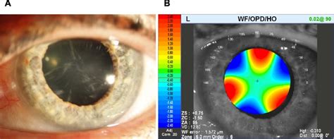 Anterior Cortical Cataract In The Left Eye Of A 72 Year Old Female