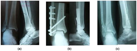 Gustilo Iii A Fracture Luxation Of The Ankle Weber C Ao Ota 44 C
