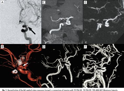 Methods And Time Schedule For Follow Up Of Intracranial Aneurysms Treated With Endovascular