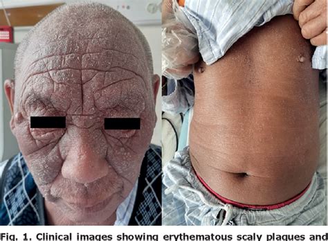 Figure 1 From Hyperpigmentation In An Elderly Patient With Atopic