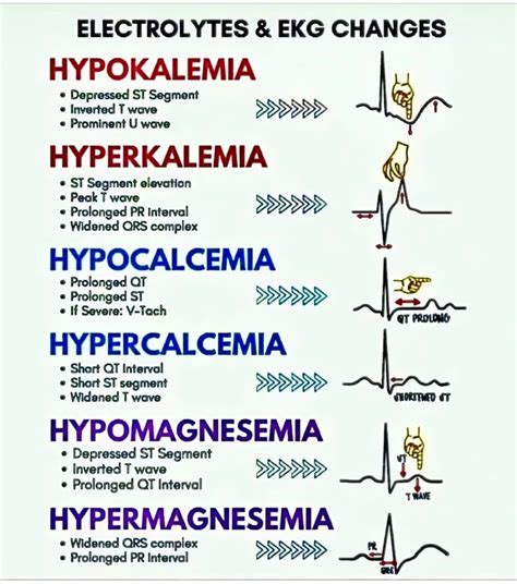 Mohd Shoib On Linkedin Ekg Cardiac