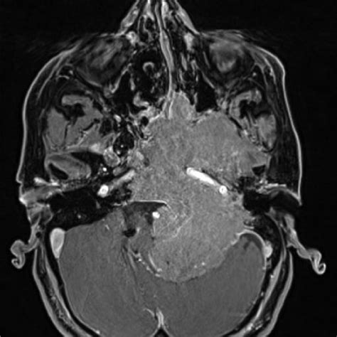 Simpson Grading System On Meningioma Resection Download Table