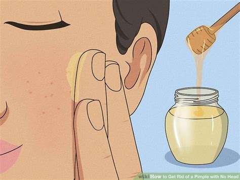 Ways To Get Rid Of A Pimple With No Head WikiHow Ways To Get Rid Of A Pimple With No Head WikiHow