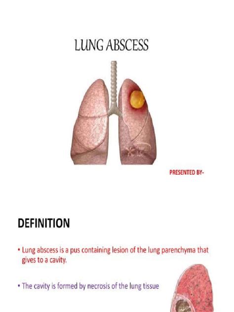 Lung Abscess Pdf