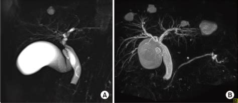 Magnetic Resonance Cholangiopancreatography Findings A Biliary Download Scientific Diagram