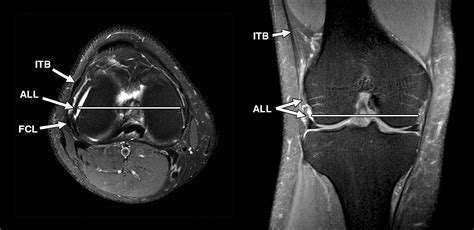 Knee Anatomy Mri