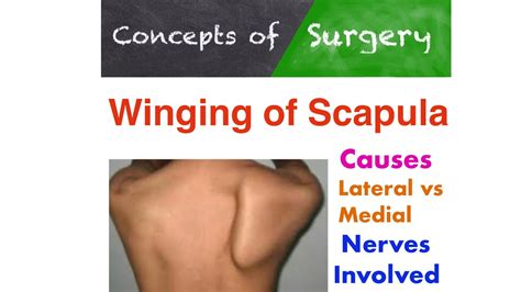 Winging Of Scapula The Three Culprit Nerves Youtube