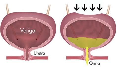Pérdida De Orina Durante La Menopausia Ginecoestetica