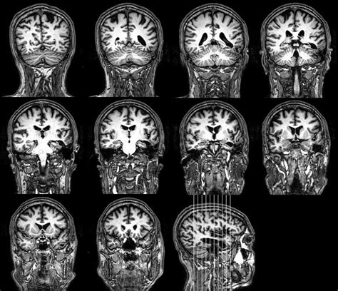 Coronal MRI Slices For Patient JB Download Scientific Diagram