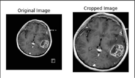 Figure 1 From Brain Tumor Detection Using Transfer Learning With Alexnet And Cnn Semantic Scholar