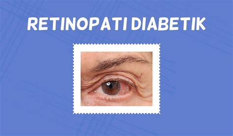 Retinopati Diabetik 2 Kondisi Diabetes Pada Mata